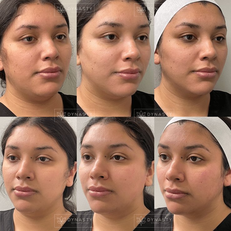 Gallery: CellSound Treatment - Dynasty Dermatology