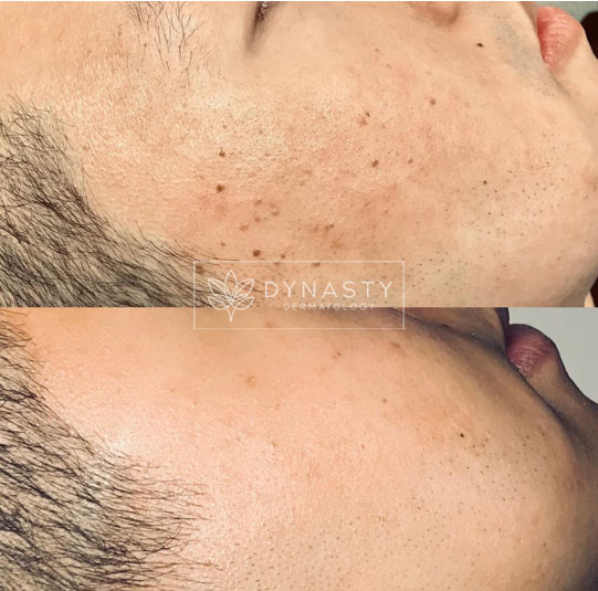 Gallery: Electrocautery - Dynasty Dermatology