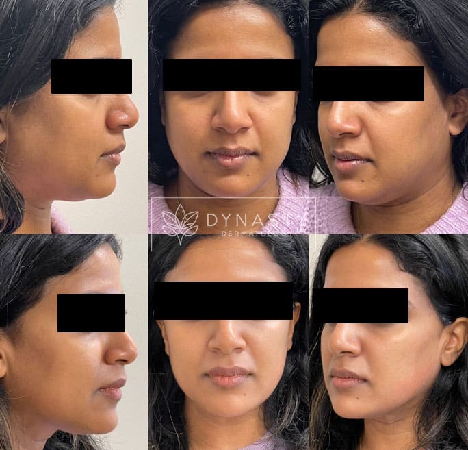 Gallery: Botox Dysport-Daxxify - Dynasty Dermatology