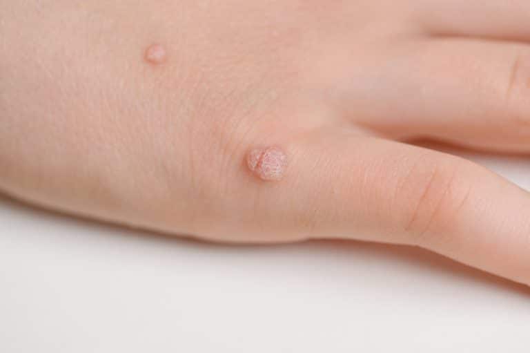 Effective Wart Removal in Pasadena, CA By Top Specialists
